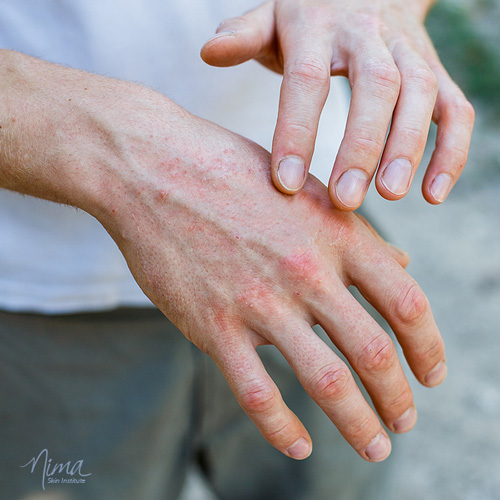 What s Making You Itch Nima Skin Institute What s Making You Itch Nima Skin Institute