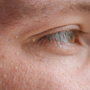 Milia: What they are and how to treat them - Nima Skin Institute